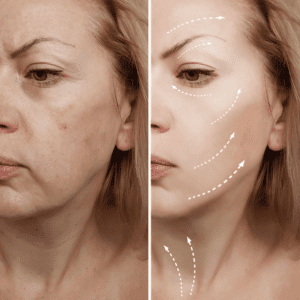Dermal Fillers in Woodinville, WA | KOCO Medical Aesthetics