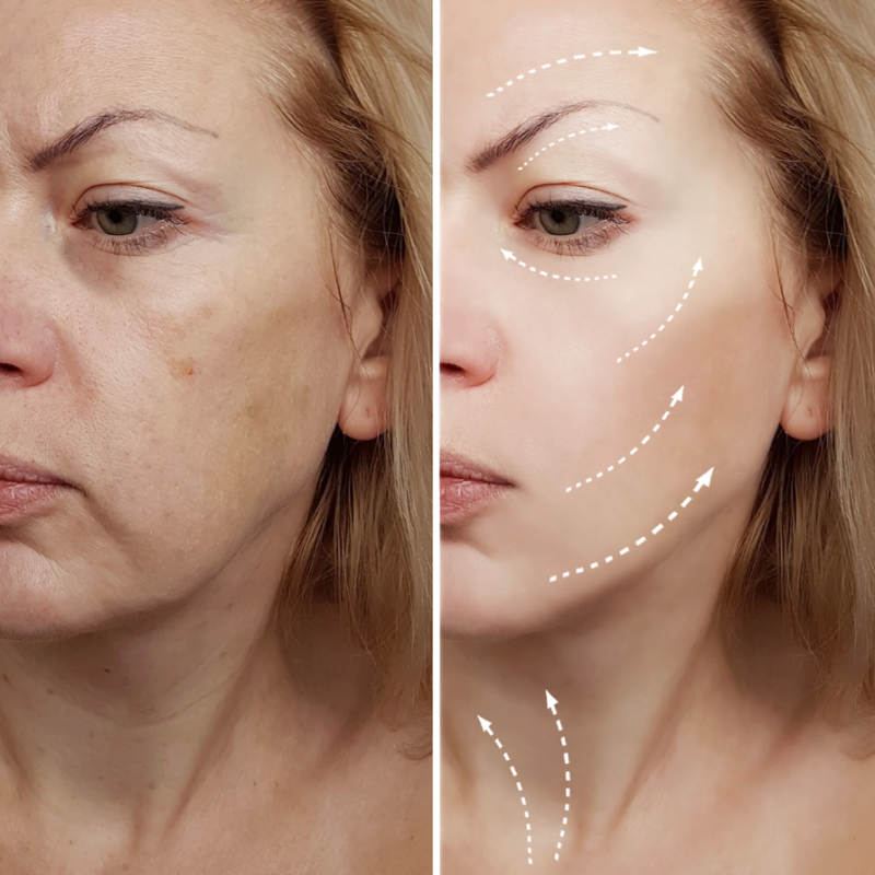 Dermal Fillers in Woodinville, WA | KOCO Medical Aesthetics