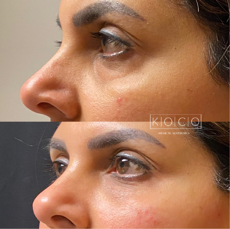 Before and After Photos Gallery | KOCO Medical Aesthetics