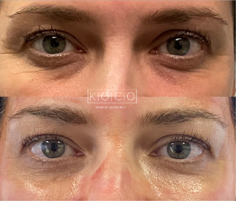 Before and After Photos Gallery | KOCO Medical Aesthetics