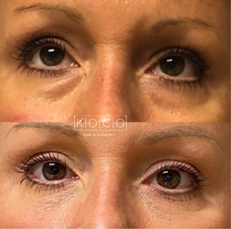 Before and After Photos Gallery | KOCO Medical Aesthetics