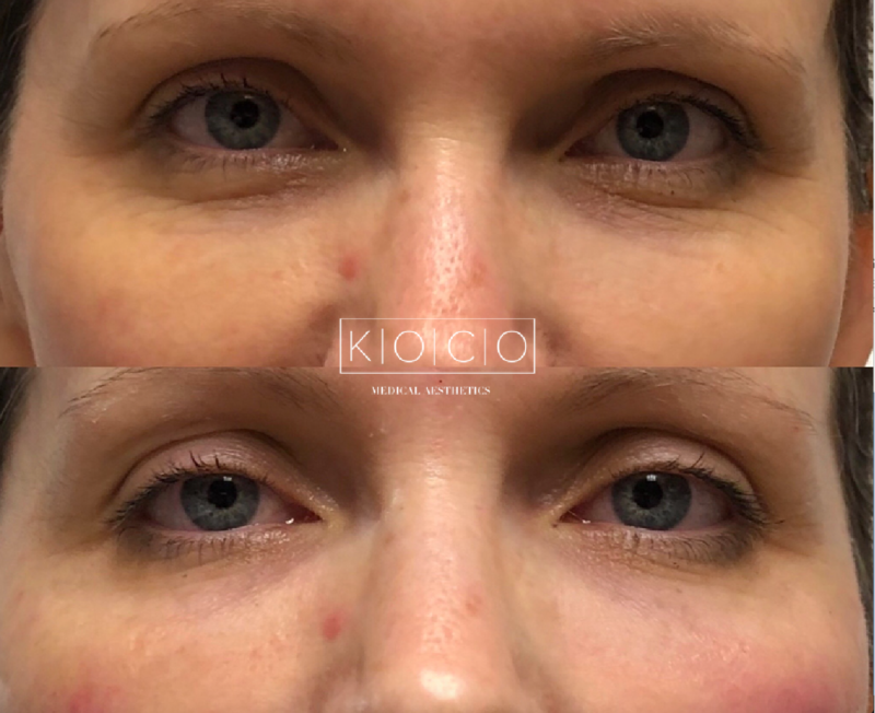 Before and After Photos Gallery | KOCO Medical Aesthetics