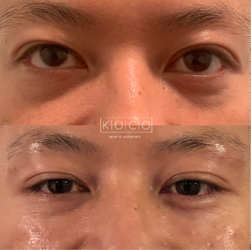 Before and After Photos Gallery | KOCO Medical Aesthetics